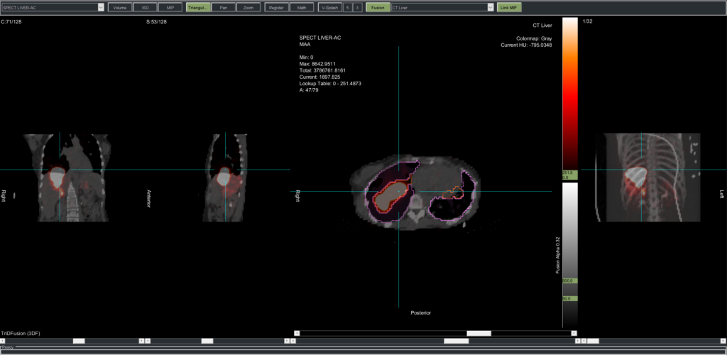 3D SPECT Lung Shunt & Lung Dose – Daniel Lafontaine